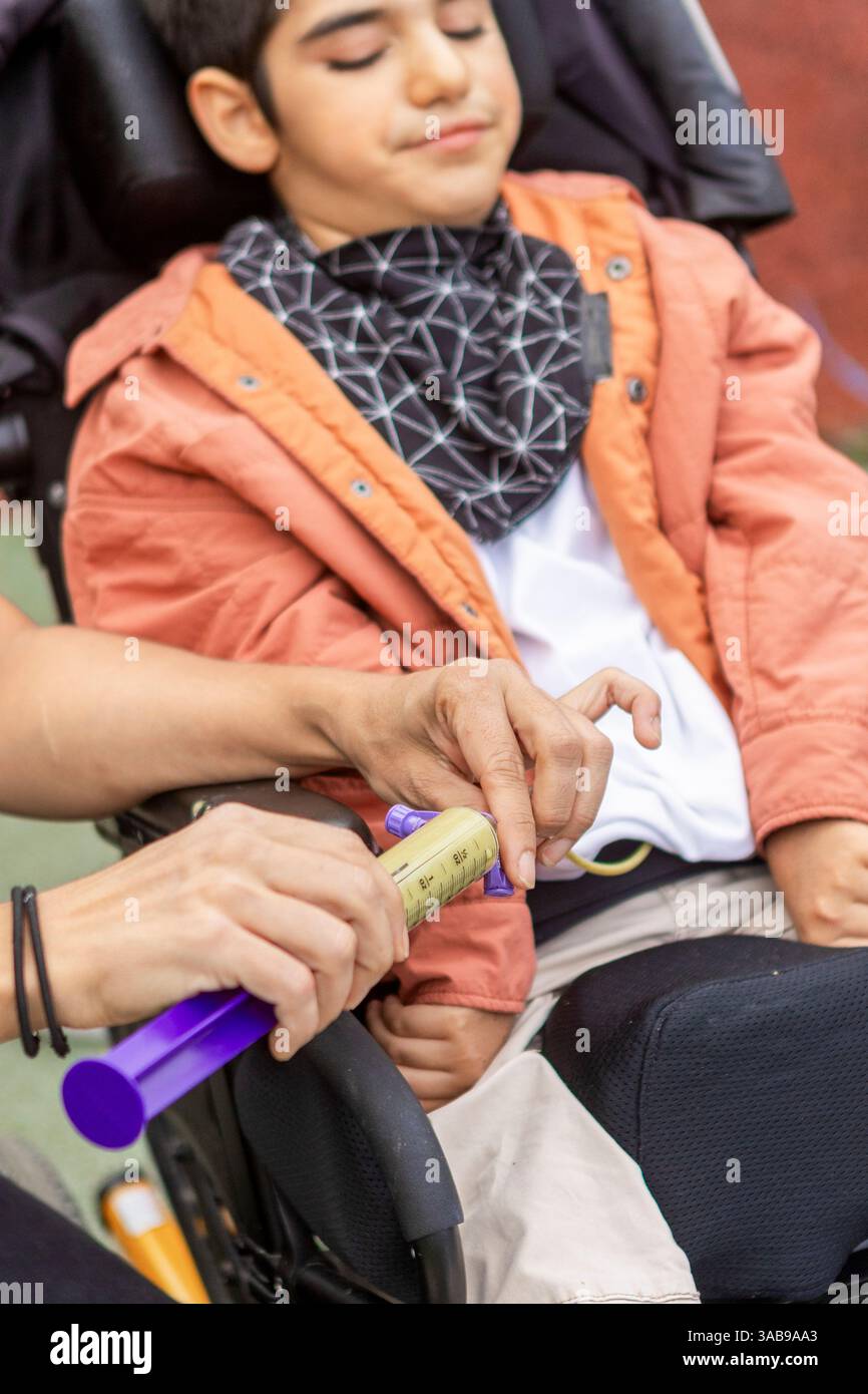 A child with cerebral palsy is receiving nutrition through a feeding ...