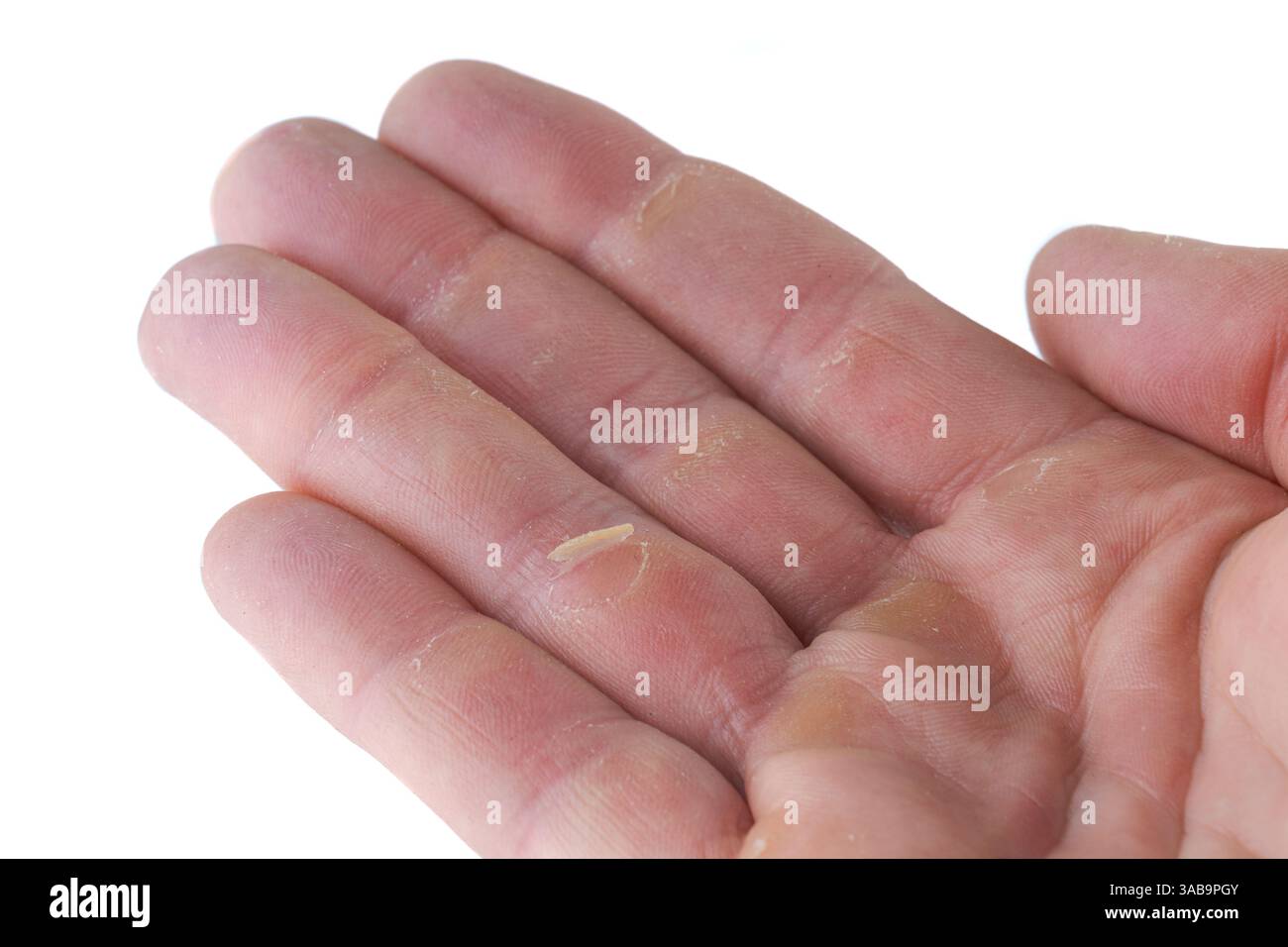 A flapper, a piece of skin, hanging from a wound on a ring finger ...
