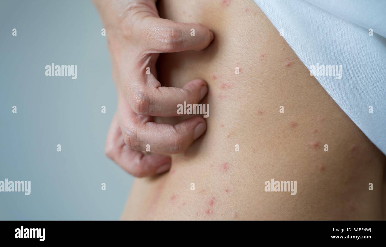Rash With Bumps, Scabs. Females sunburned back, psoriasis Skin. Skin allergic to cosmetics and ...