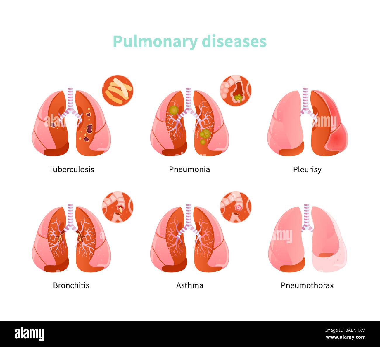 Set lung diseases. Tuberculosis, pneumonia, pleurisy, bronchitis asthma ...