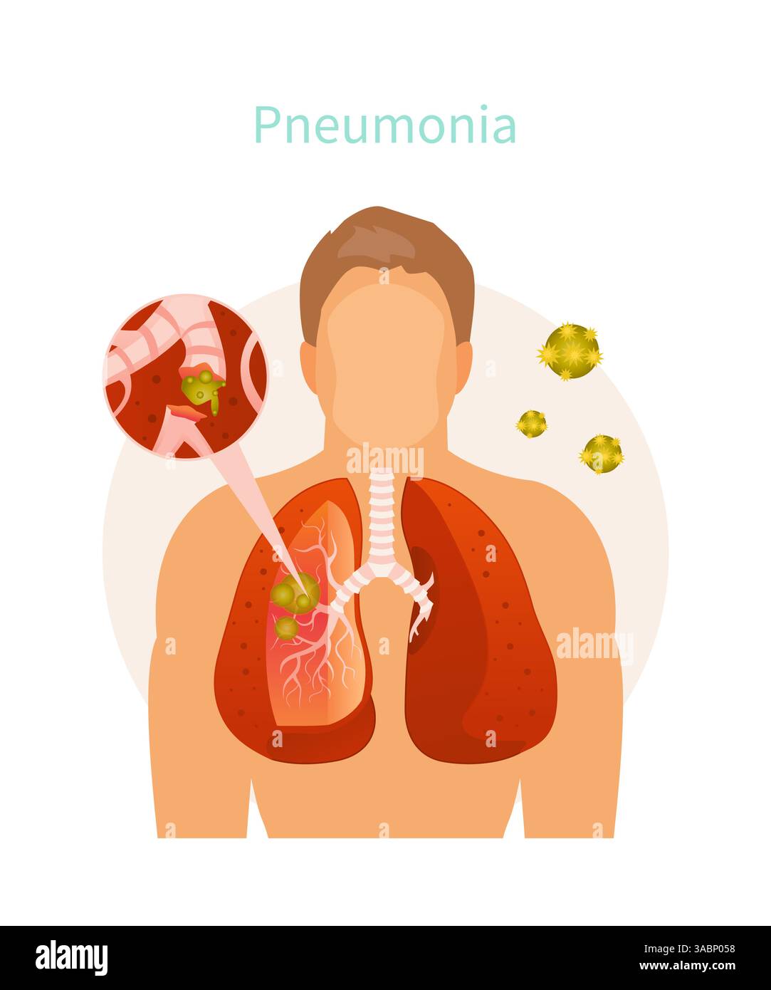 Male character with the symptoms and treatment of pneumonia. Vector ...