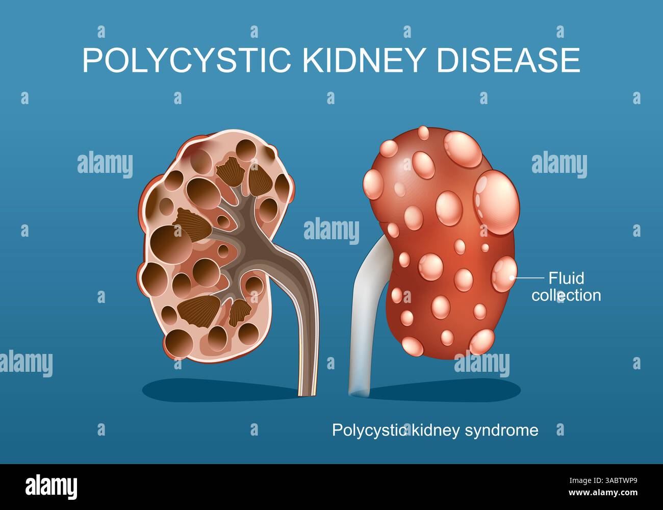 Human kidney medical diagram hi-res stock photography and images - Alamy