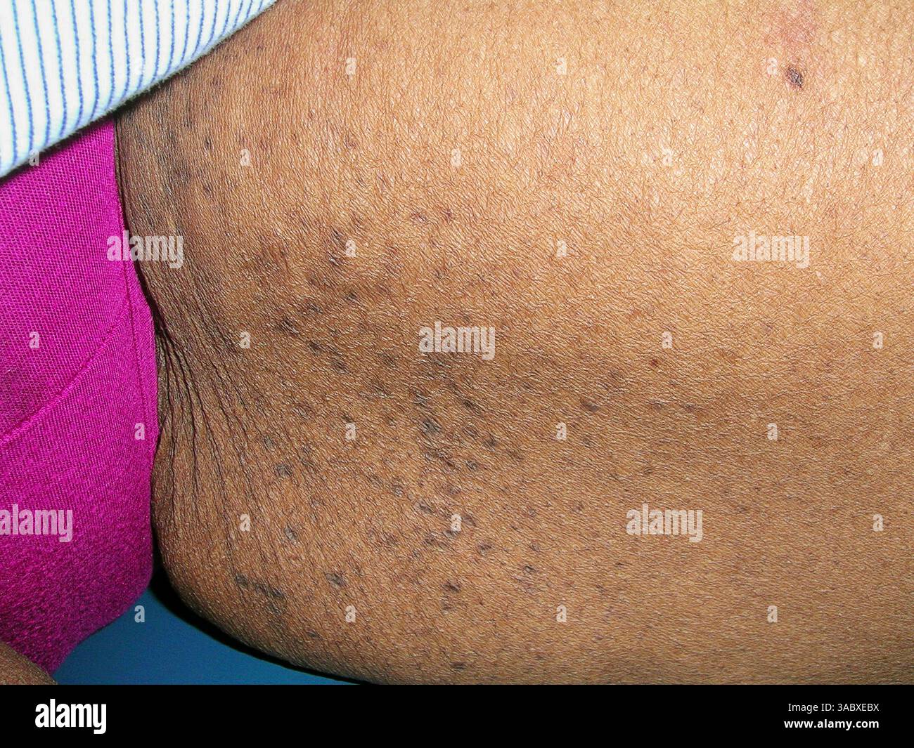 Atrophic lichen planus on a patient's skin. Lichen planus is an ...