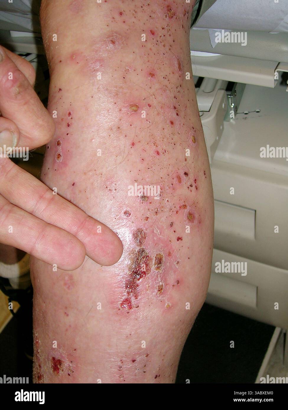 Bites and ringworm infection on a 66 year old male patient's leg. The ...