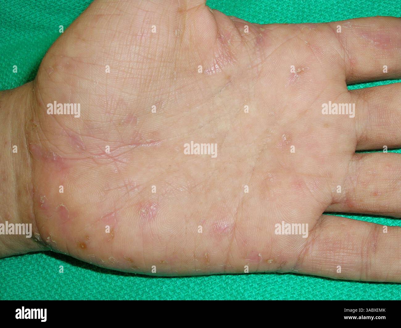 Crusted scabies infection on the hand of a young adult patient. Scabies ...