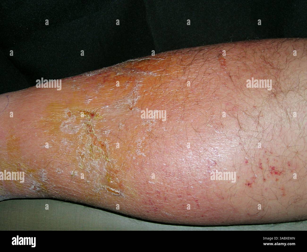 Cellulitis and impetigo on a patient's skin. Impetigo is a bacterial ...