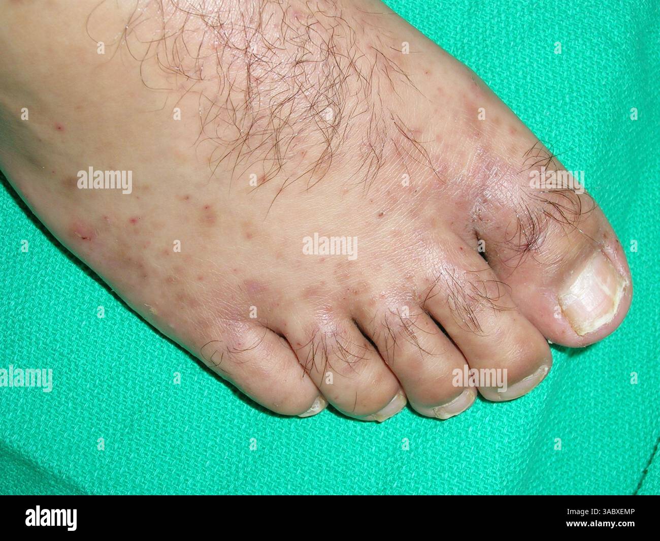 Crusted scabies infection on the foot of a young adult patient. Scabies ...
