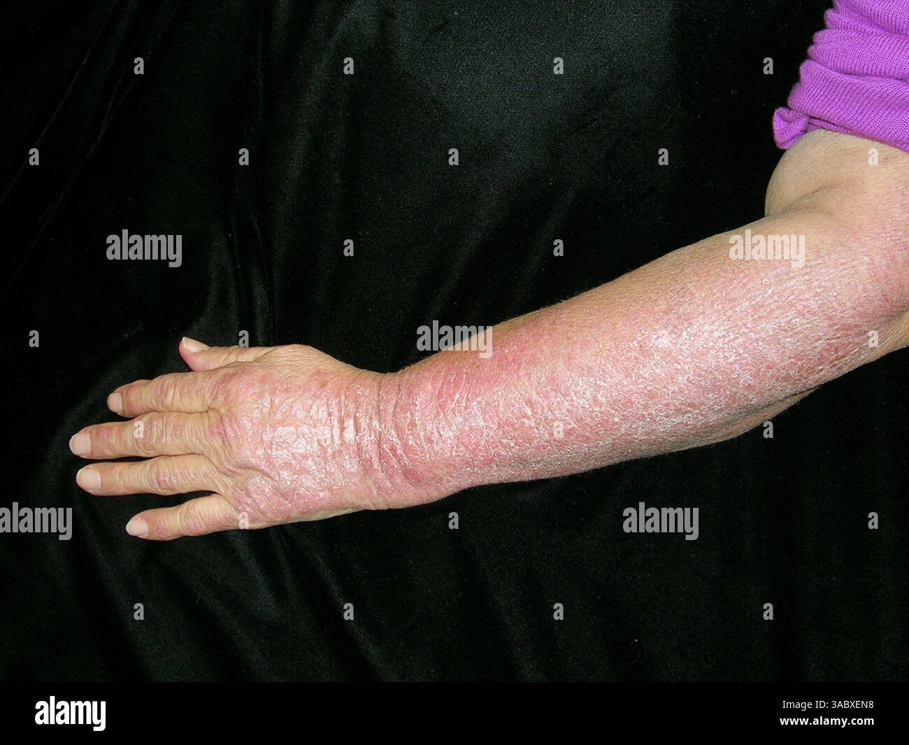 Rash on the arm of a patient with dermatomyositis. Dermatomyositis is ...