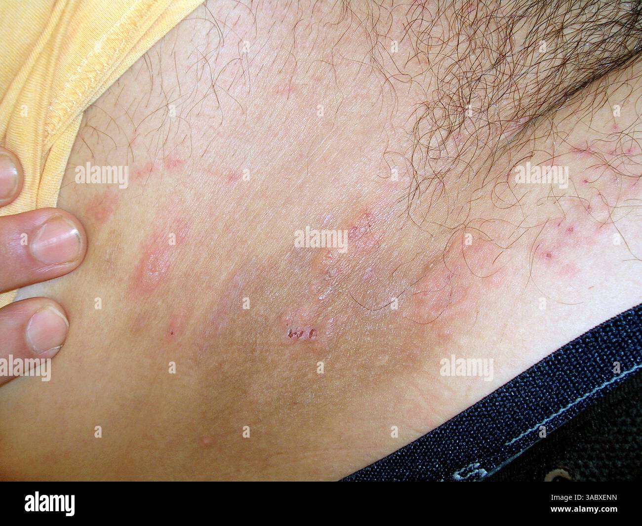 Dermatitis herpetiformis (DH, or Duhring's disease) on a patient's ...
