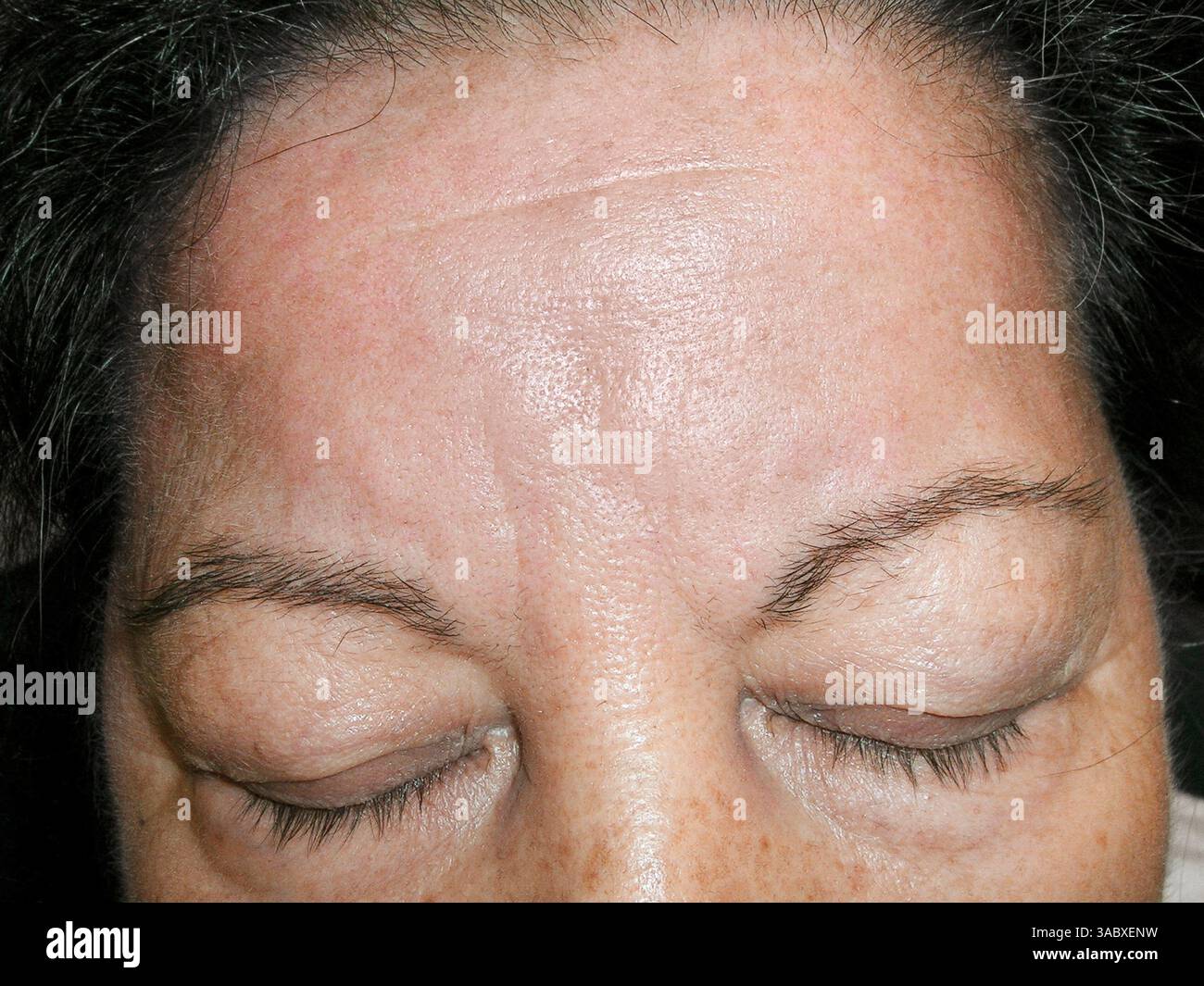 Rash on the forehead of a patient with dermatomyositis that is ...