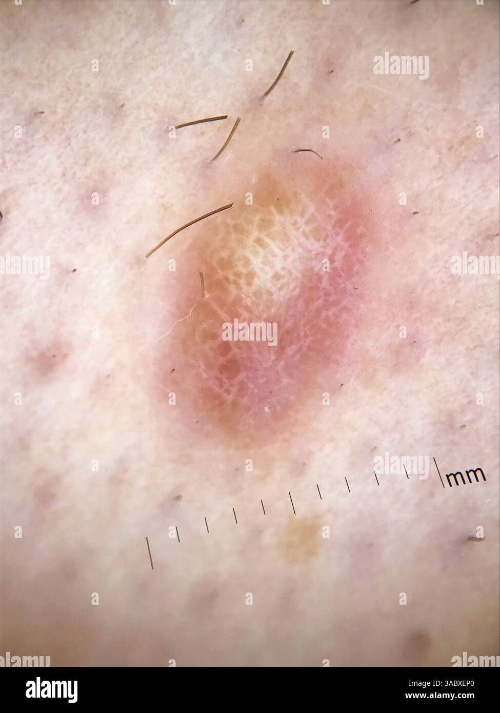 Dermatoscope image of a dermatofibroma on a patient's leg ...