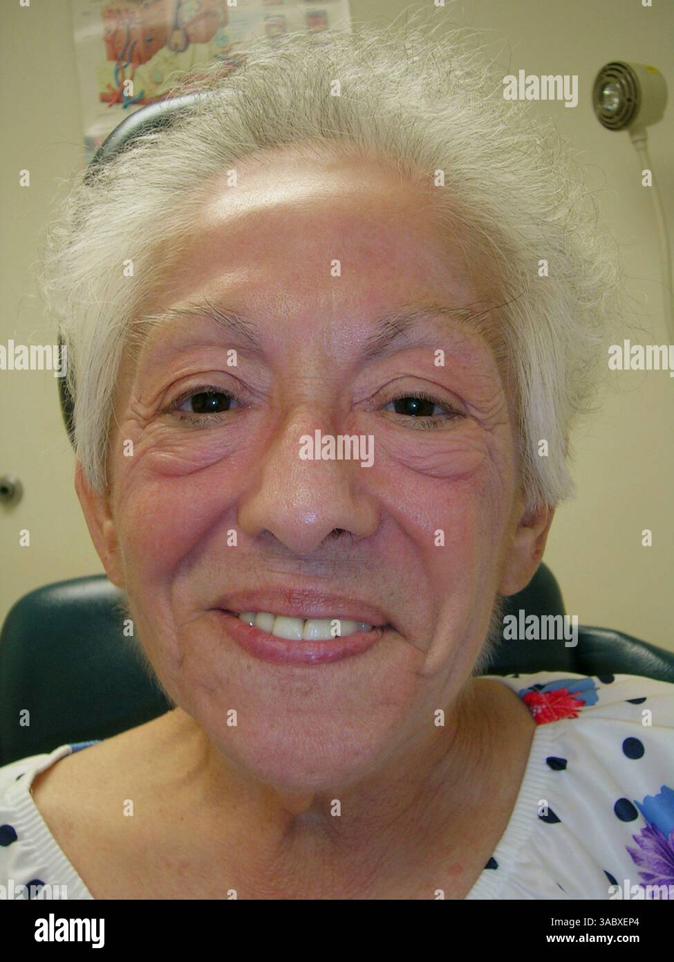 Rash on the face of a patient with dermatomyositis that is improving ...