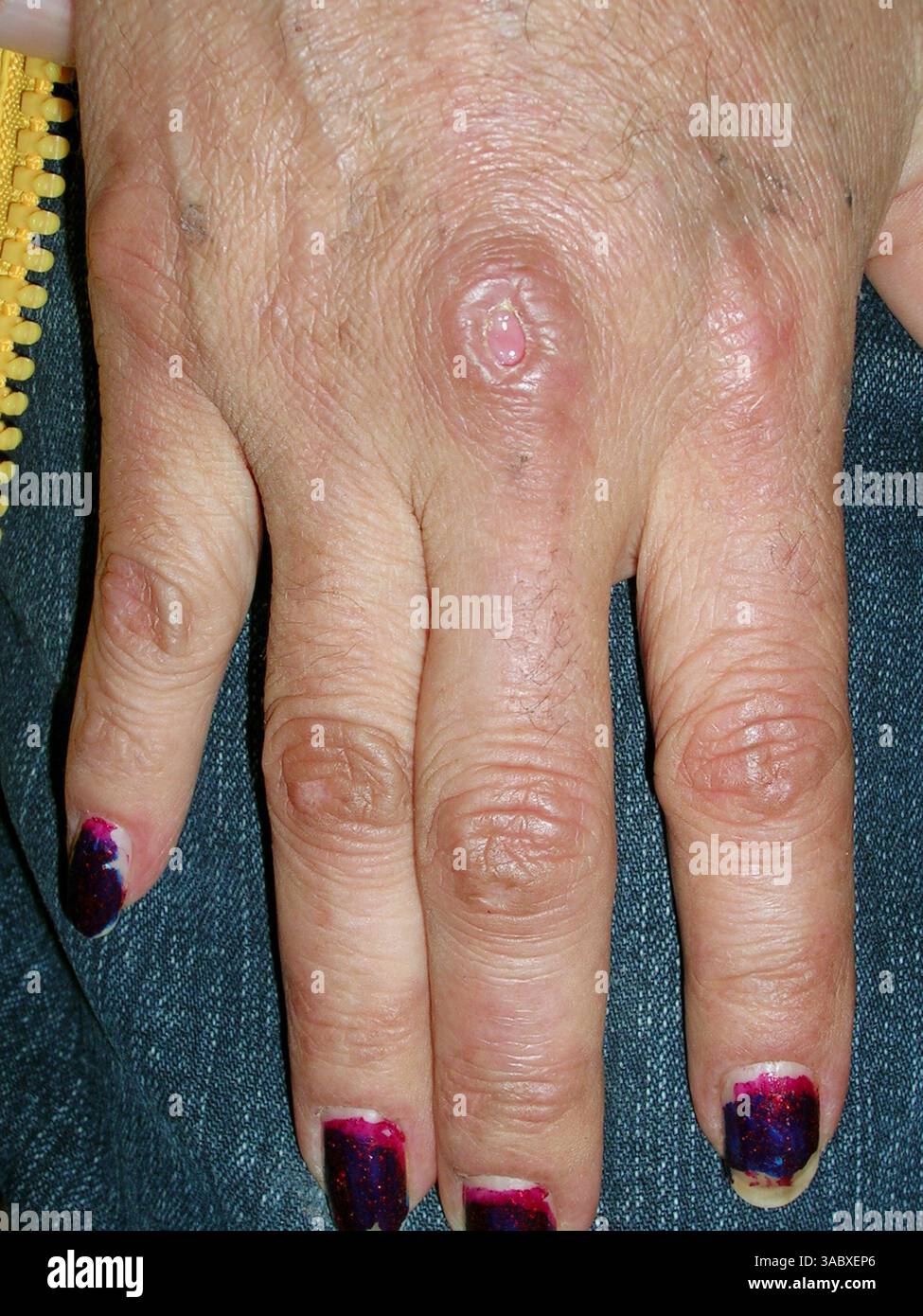 Gottron's papule (dry patch) over the knuckle of a patient, associated ...