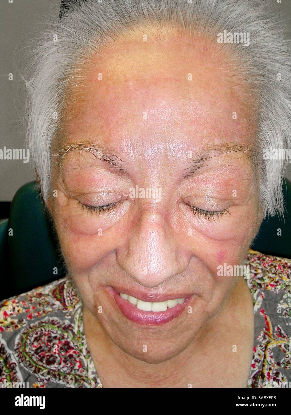 Rash on the face of a patient with dermatomyositis that is slowly ...