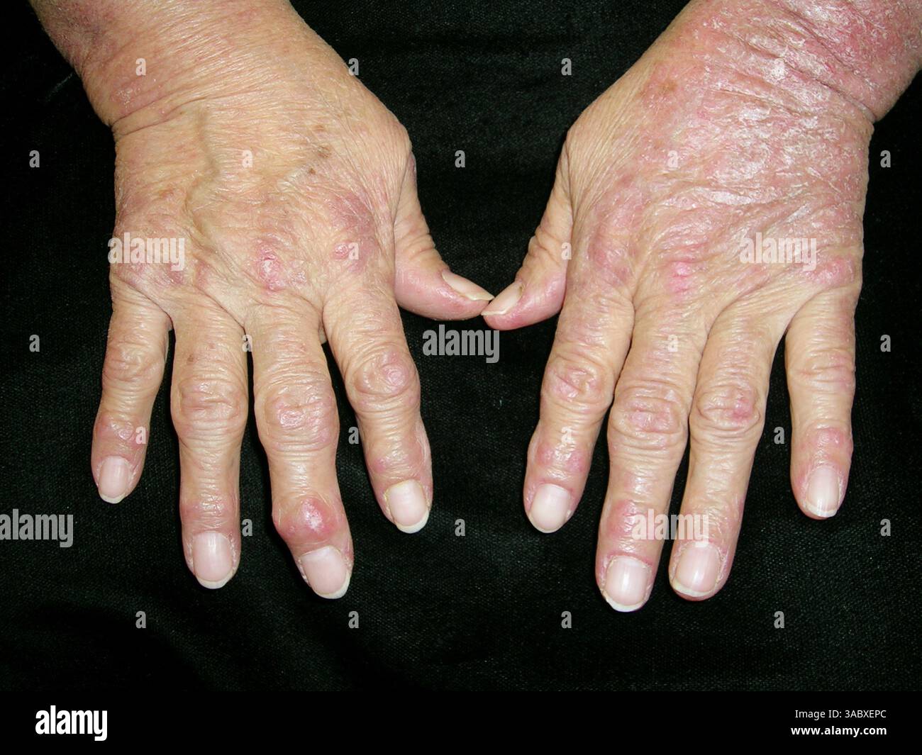 Gottron's papules (dry patches) over the knuckles of a patient ...