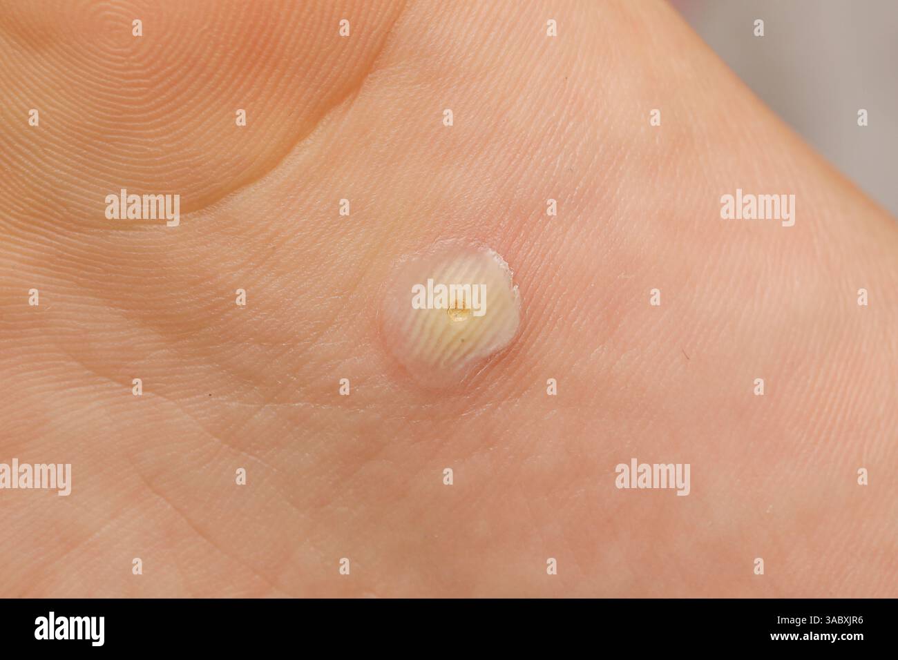 Close-up of a plantar wart being treated with salicylic acid, showing ...