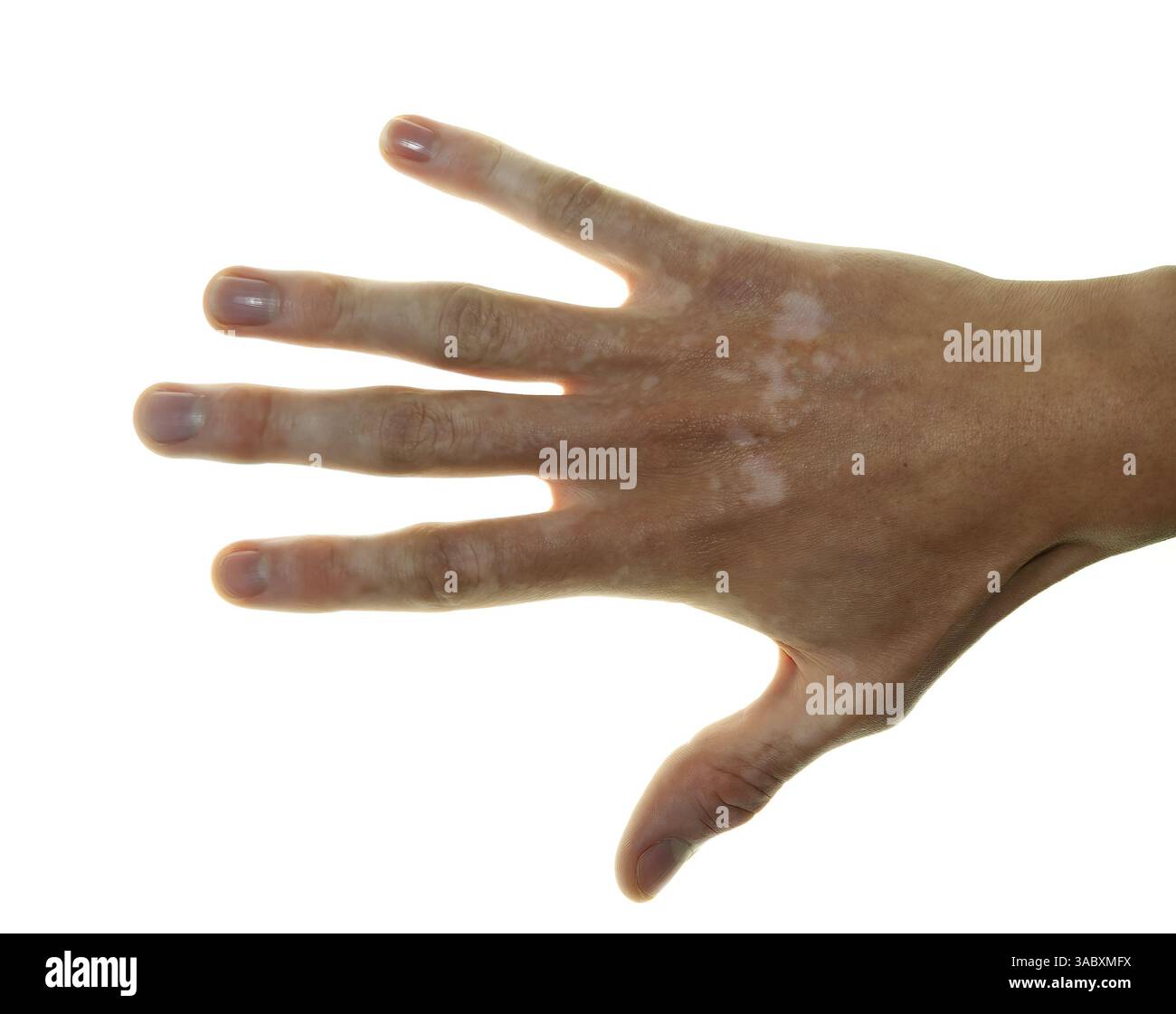 Hand vitiligo showing skin hi-res stock photography and images - Alamy
