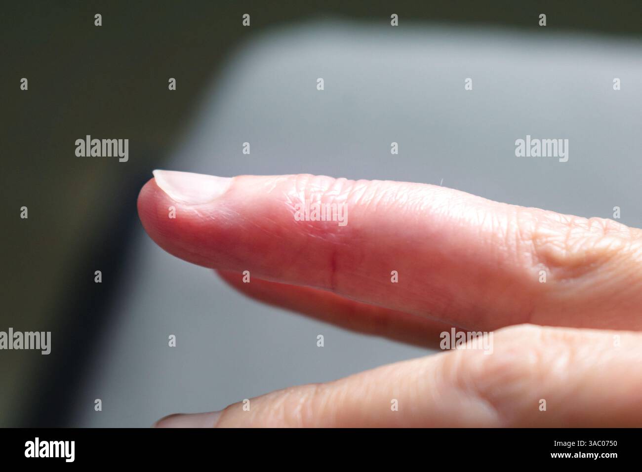 Mallet finger healing after splint removal from middle finger following ...