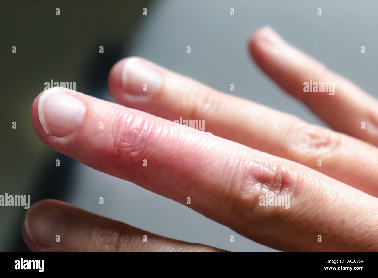 Mallet finger healing after splint removal from middle finger following ...