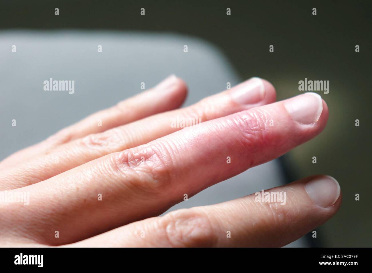 Mallet finger healing after splint removal from middle finger following ...