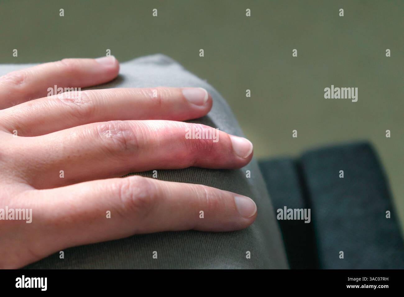 Mallet finger healing after splint removal from middle finger following ...