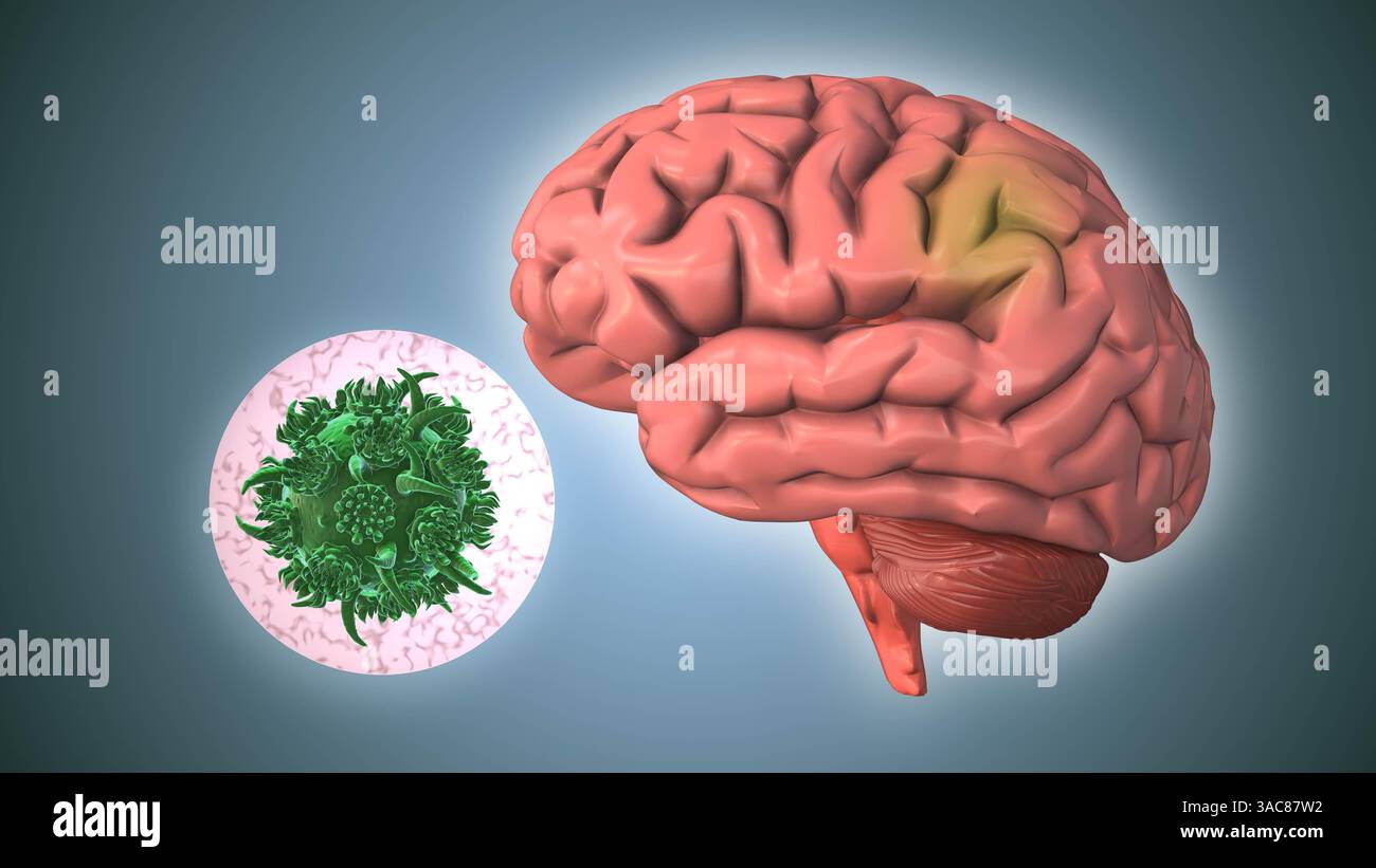Guillain Barre Syndrome Affecting Nerves and Muscle Weakness Guillain ...