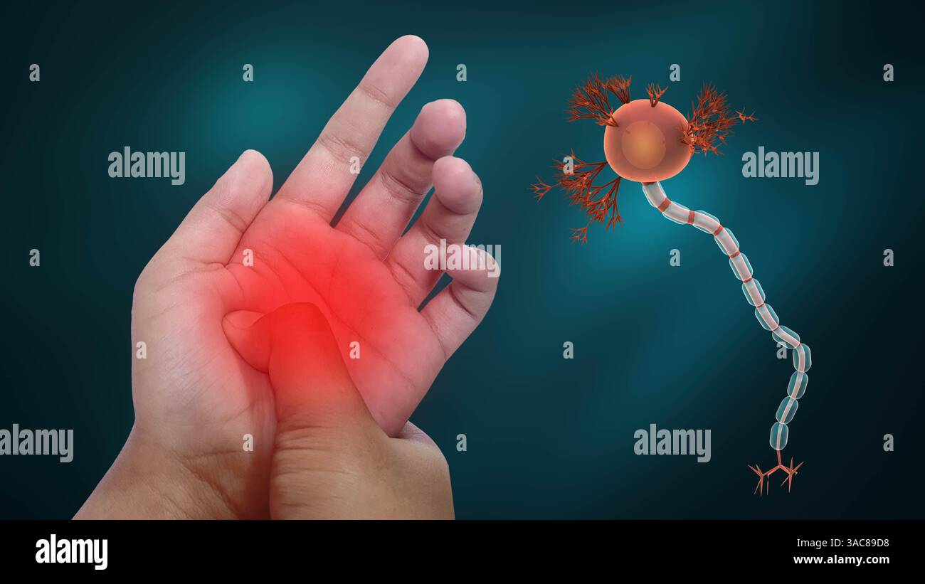 Hand Palm Sensation Loss Due to Guillain Barre Syndrome Stock Photo - Alamy