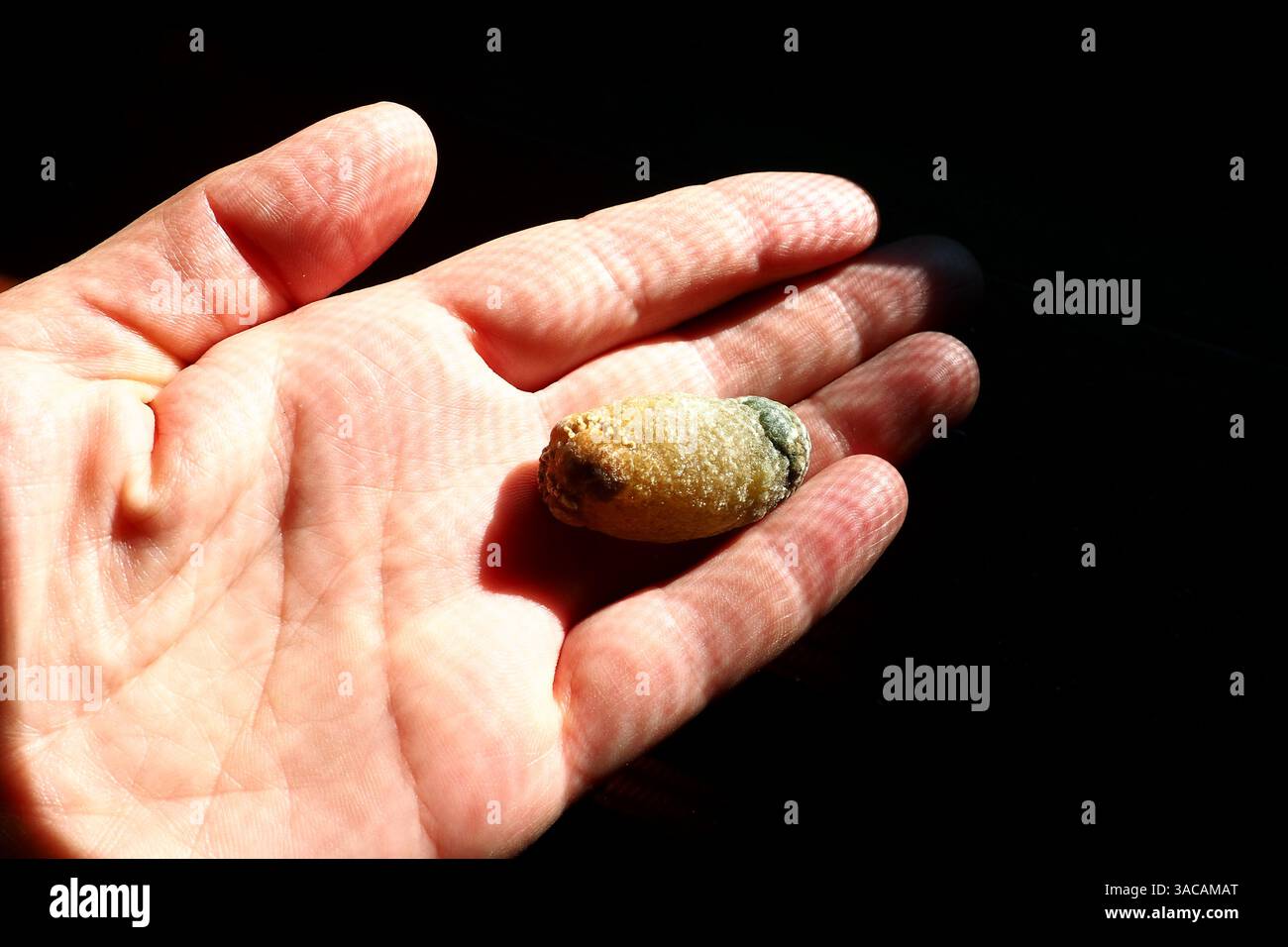 Gallstone disease, cholelithiasis - the formation of stones, stones in ...