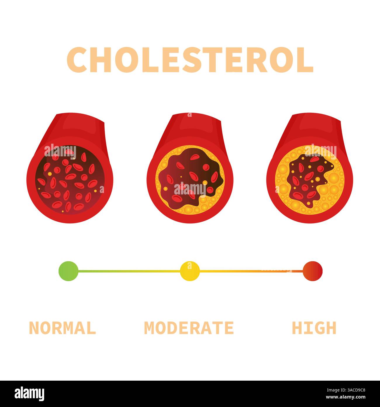 Cholesterol plaque in blood vessel medical diagram Stock Vector Image ...