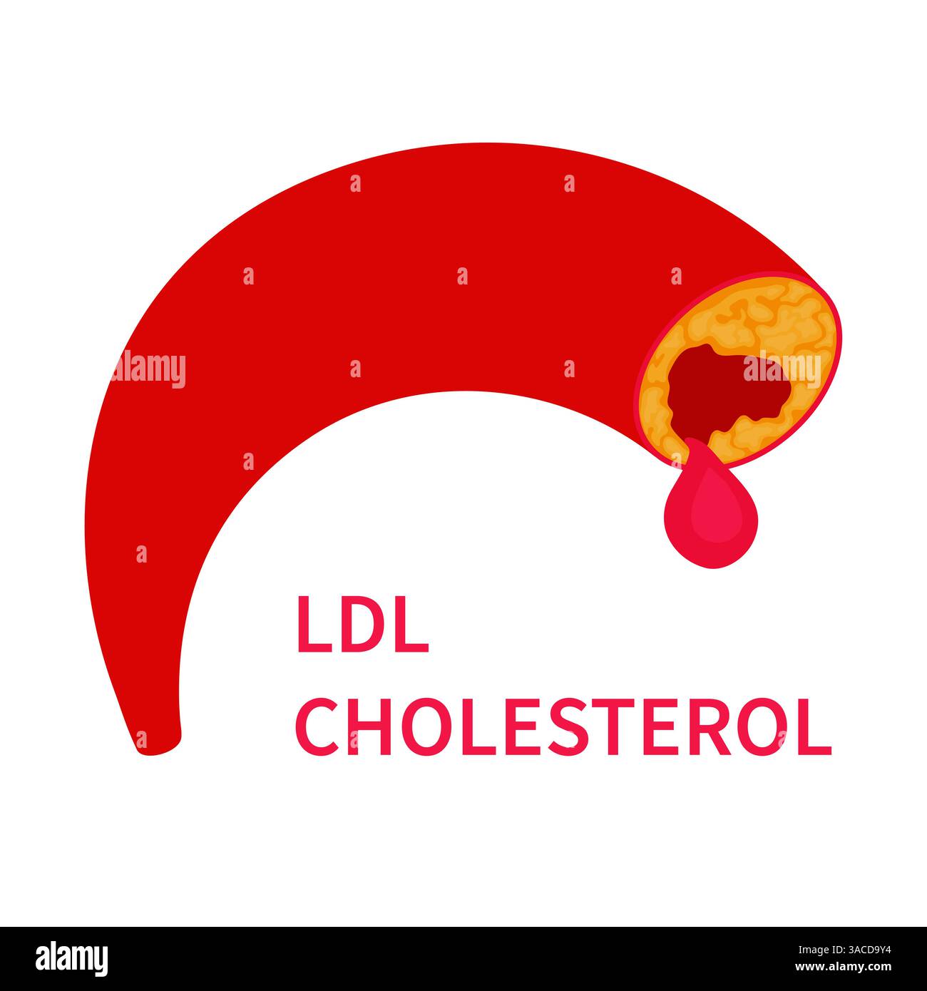 Cholesterol level meter gauge with blood vessel diagram Stock Vector ...