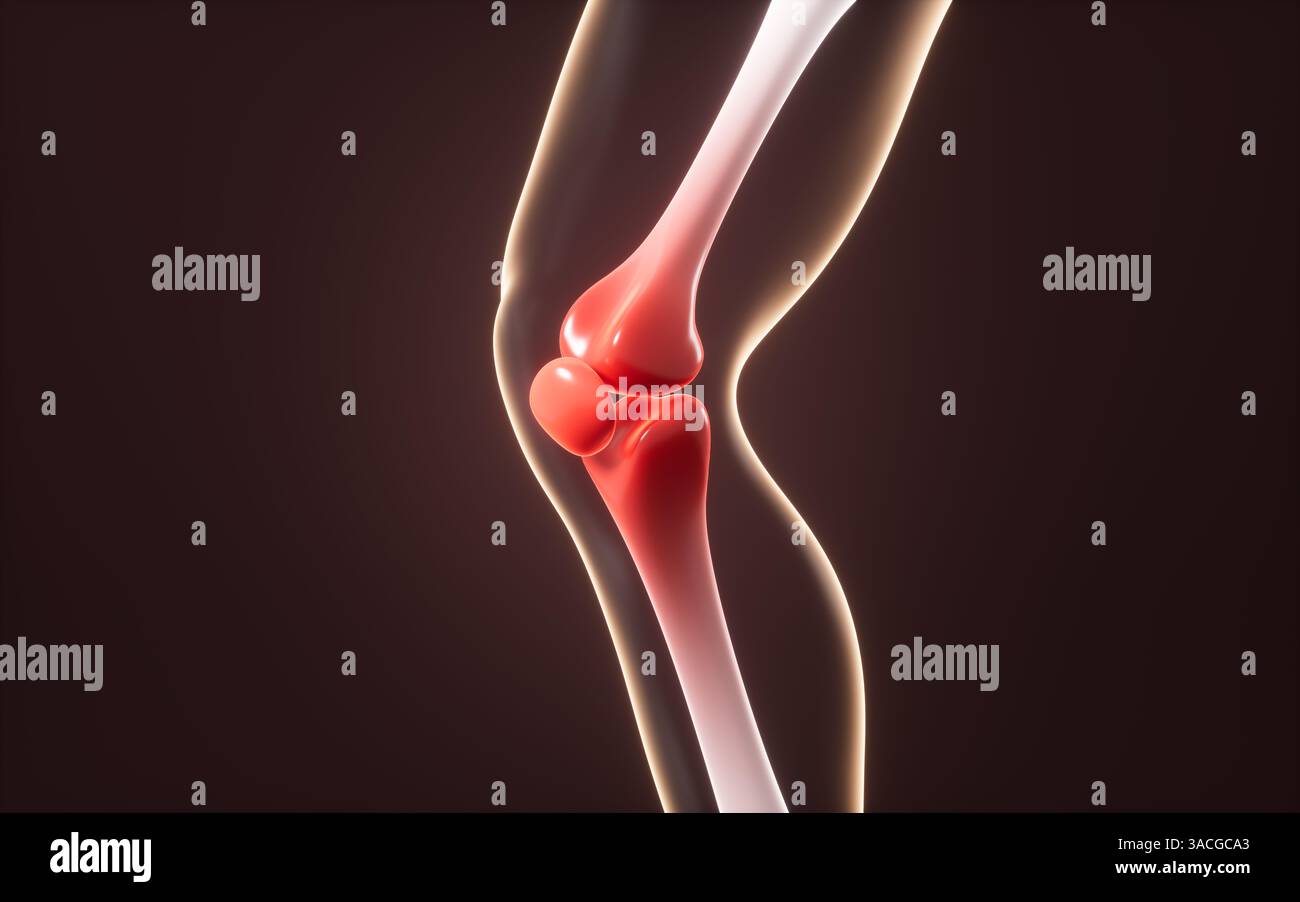 Human kneecap model, arthrophlogosis, joint swelling, joint pain ...