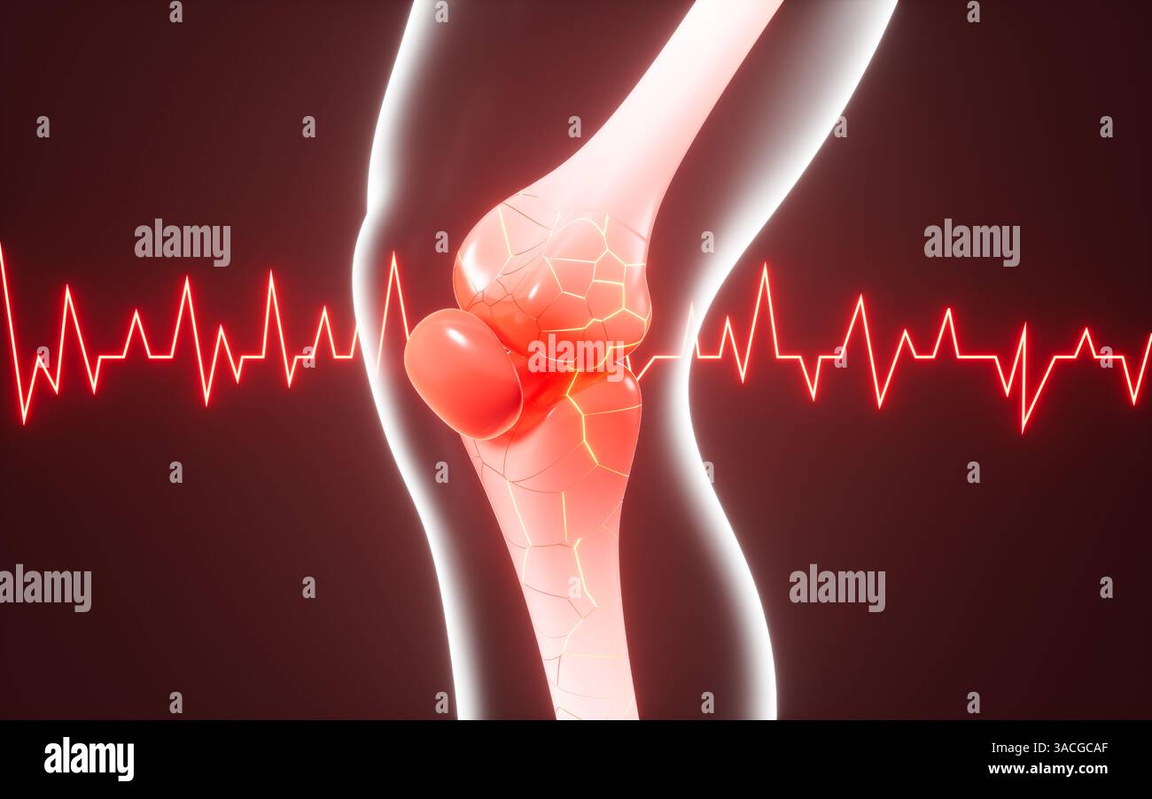 Human kneecap model, arthrophlogosis, joint swelling, joint pain ...