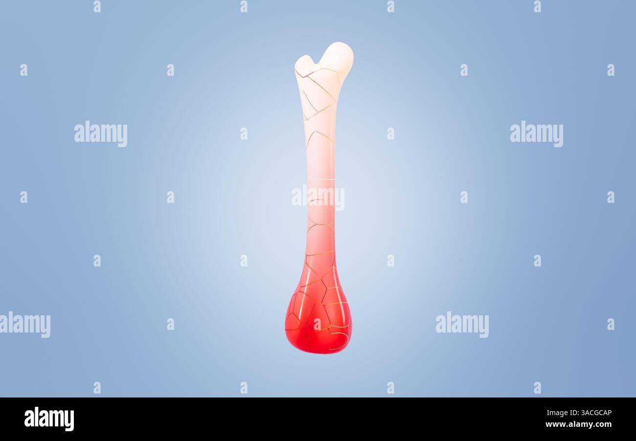 Human kneecap model, arthrophlogosis, joint swelling, joint pain ...