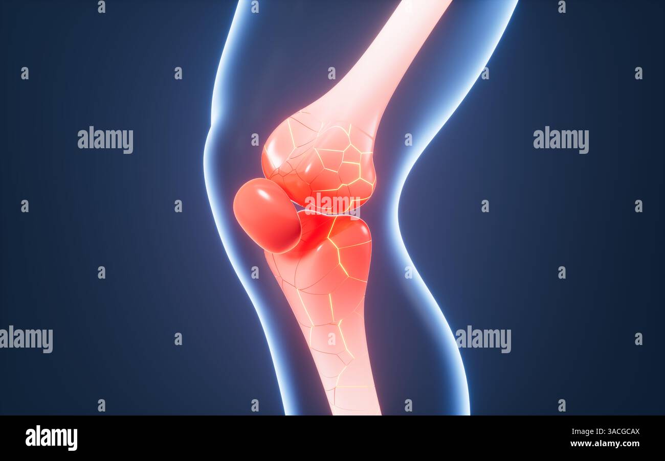 Human kneecap model, arthrophlogosis, joint swelling, joint pain ...