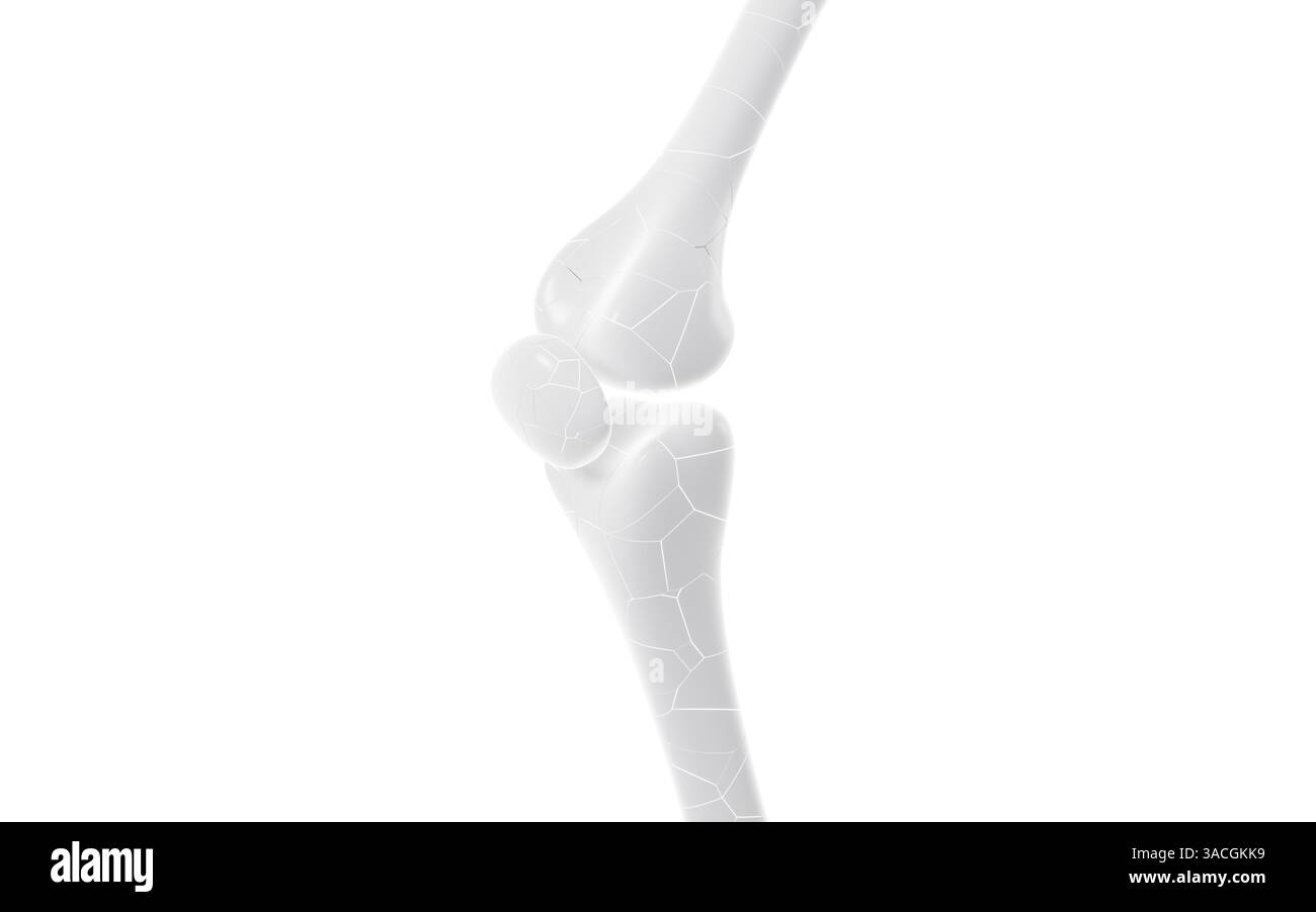 Human kneecap model, arthrophlogosis, joint swelling, joint pain ...