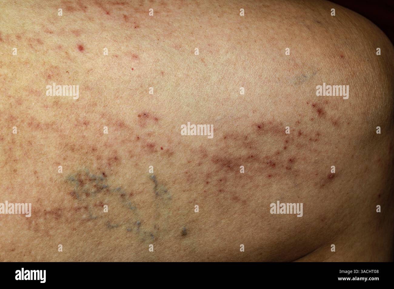Strong allergic rashes on Asian skin, body Impaired immunity and ...
