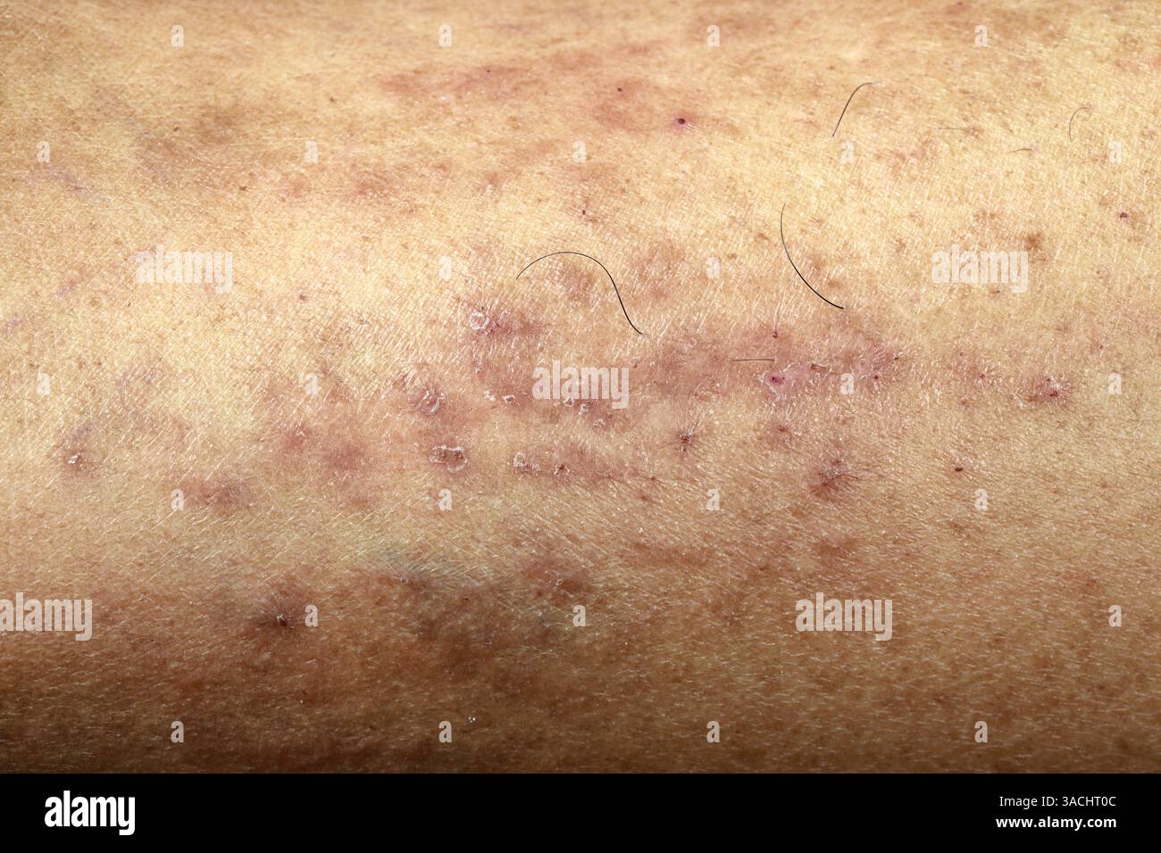 Eczema atopic dermatitis symptom skin hi-res stock photography and ...