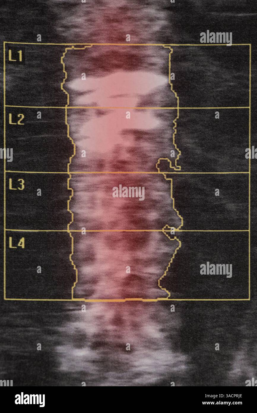 Diagnostic imaging of spinal bone density in an elderly woman with ...