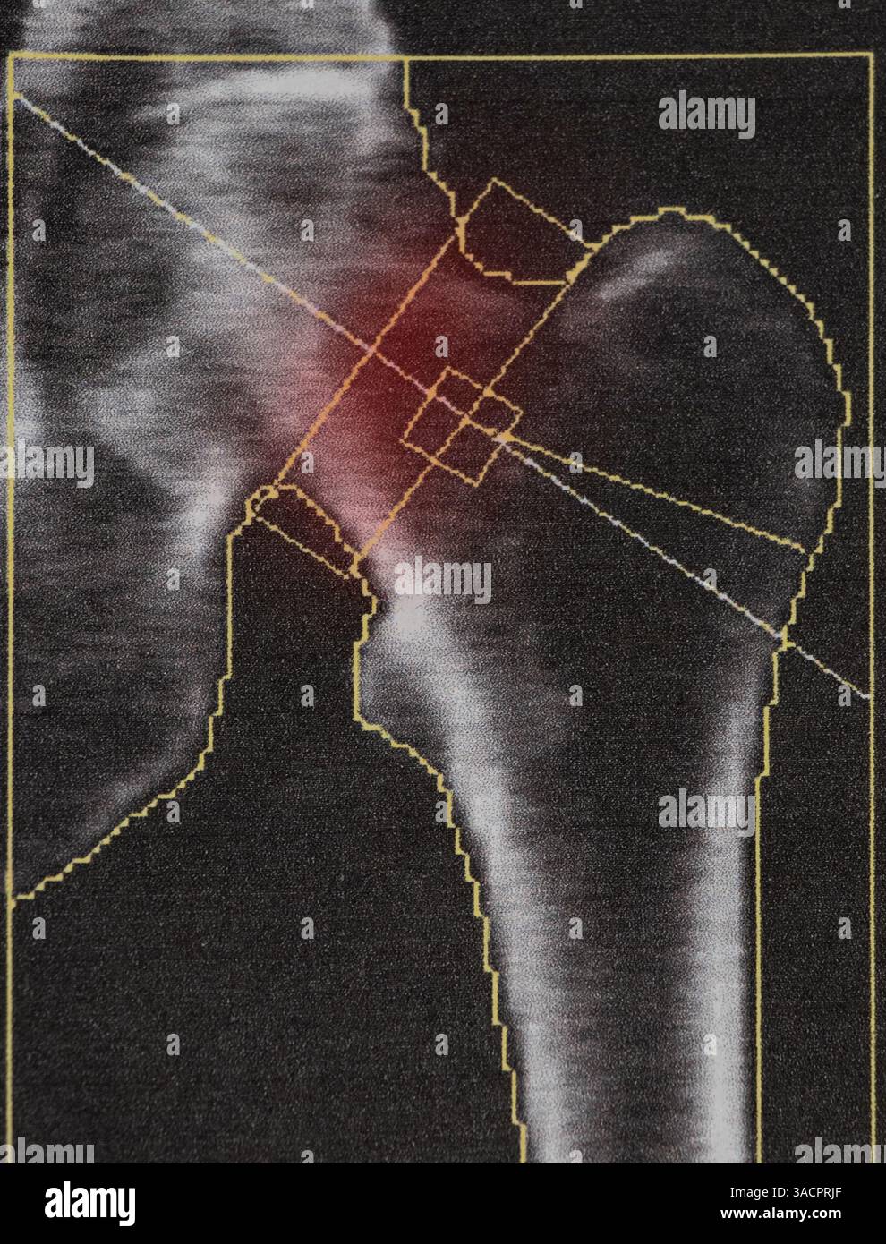 Bone density diagnostics of the femur of an elderly woman with severe ...