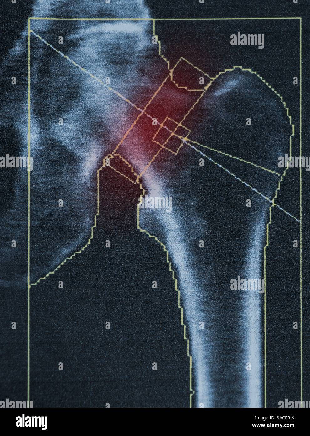 Bone density diagnostics of the femur of an elderly woman with severe ...