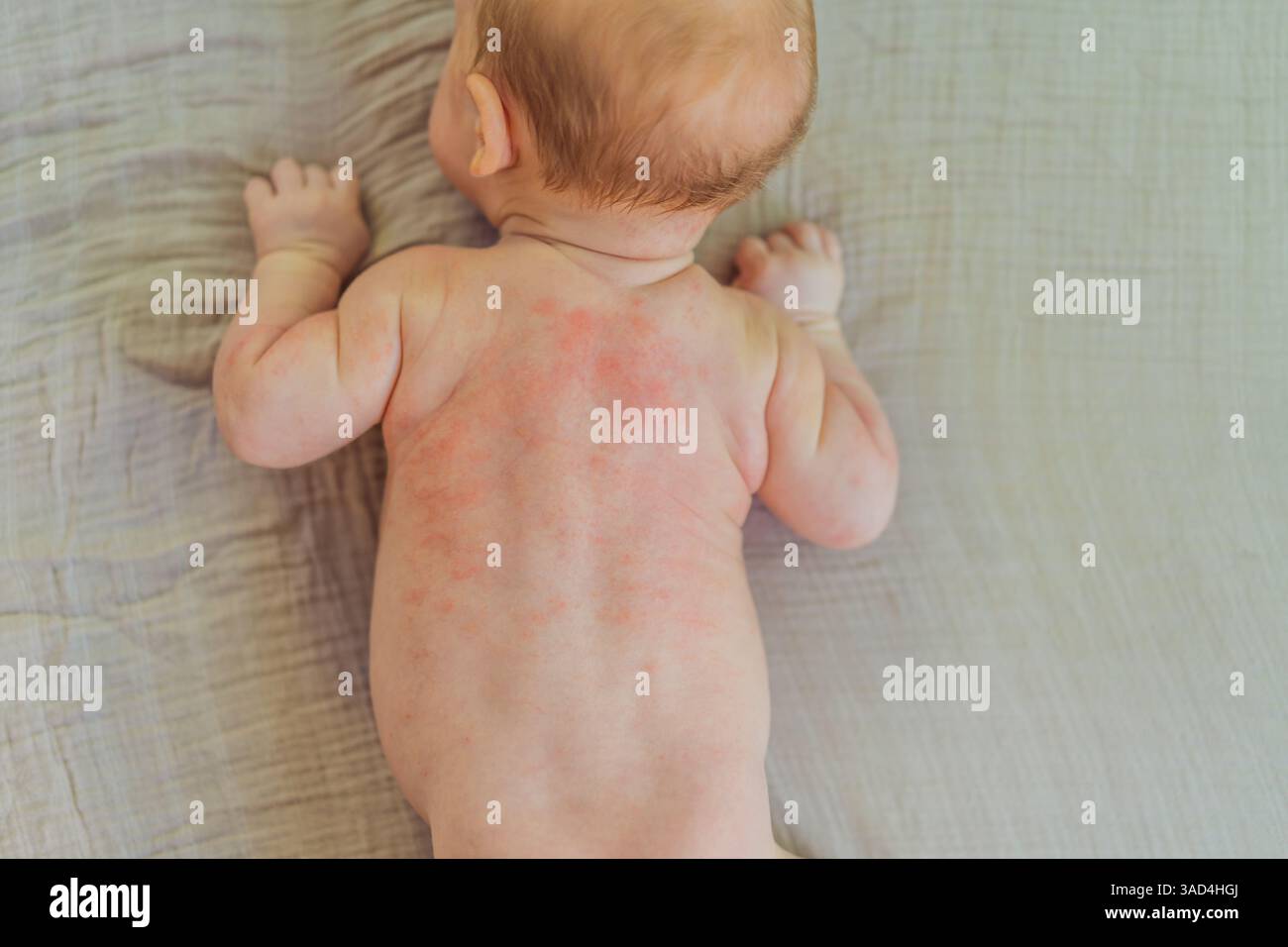 Severe heat rash on newborn baby skin. Prickly heat and skin irritation ...