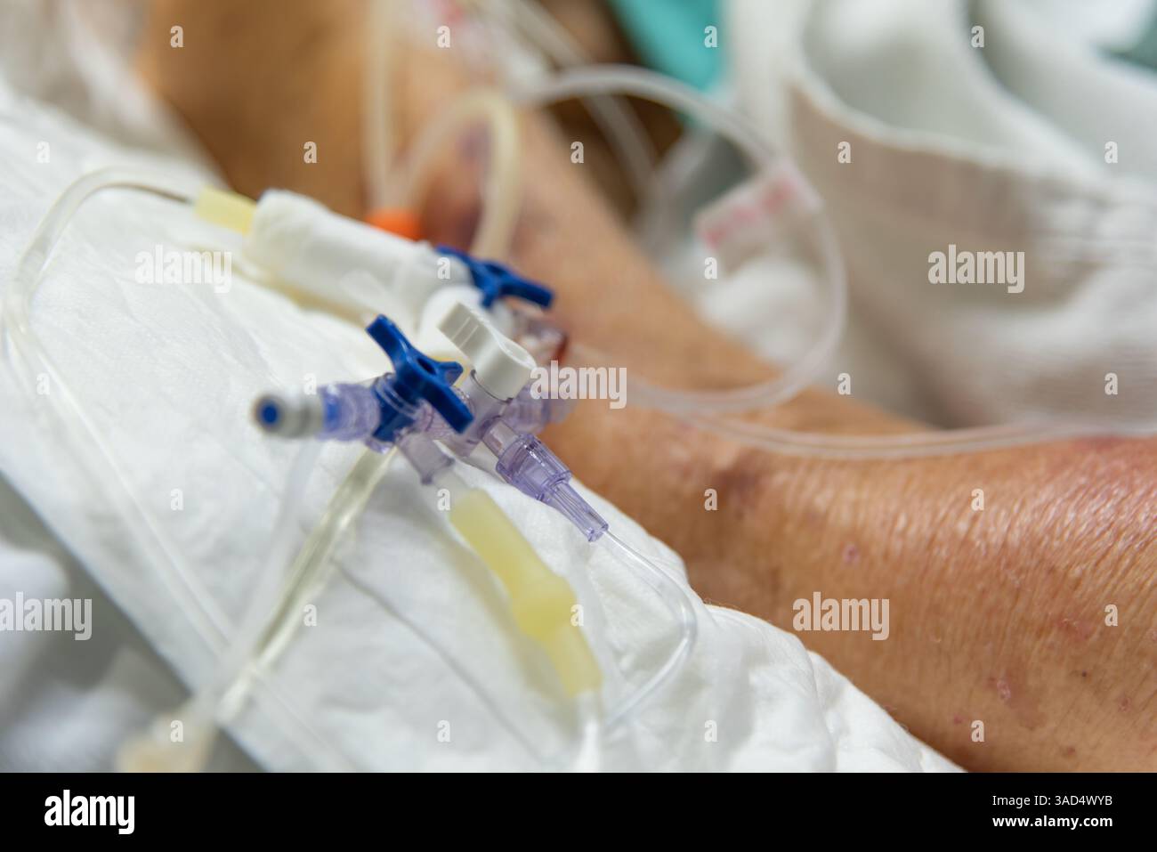 Patient asian elder women 80s flu covid19 do tracheostomy use ...