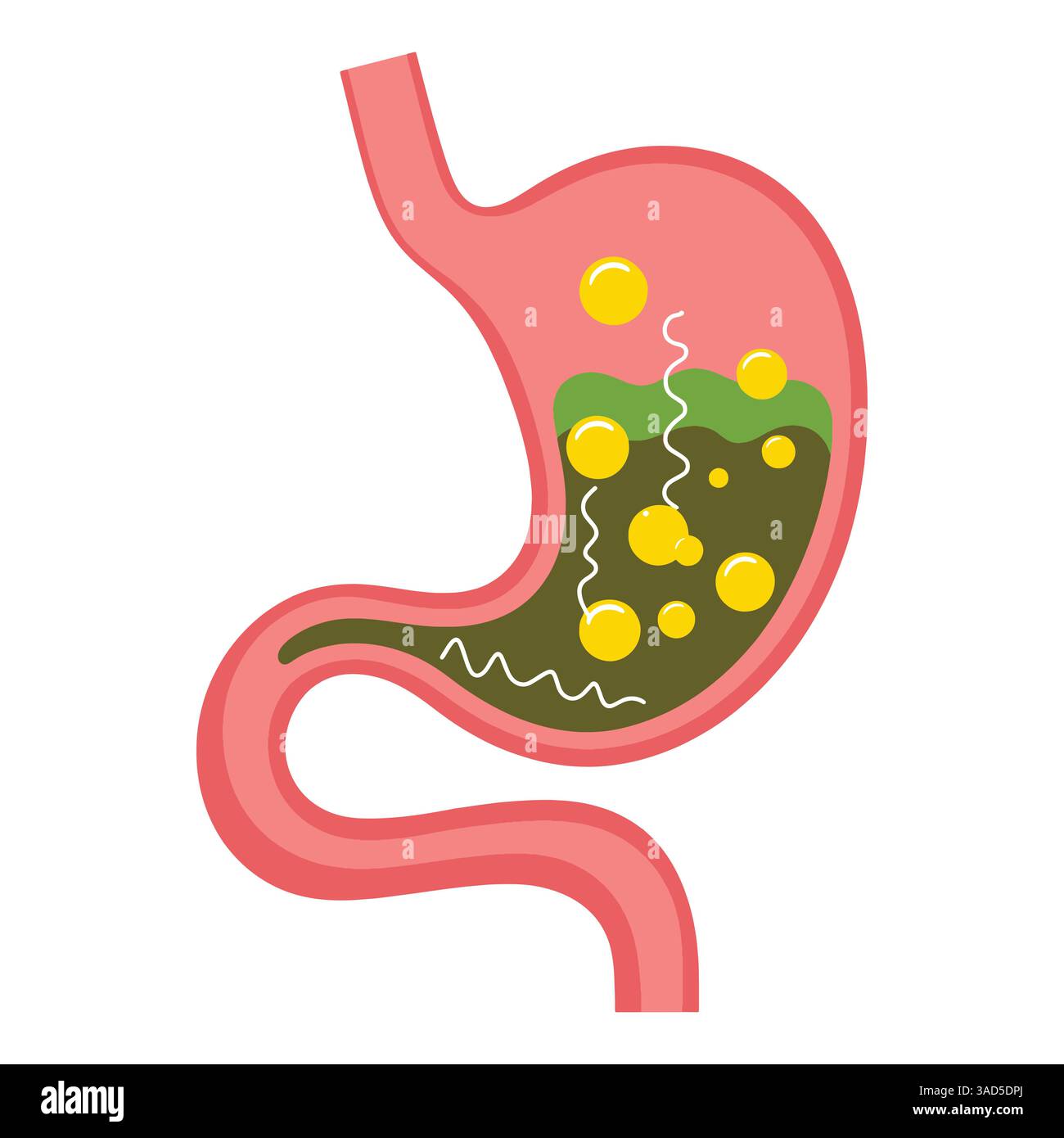 Human stomach vector illustration. Depicts gastritis, acid reflux ...