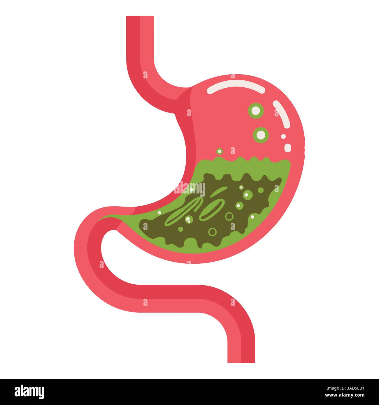 Human stomach vector illustration. Depicts gastritis, acid reflux ...