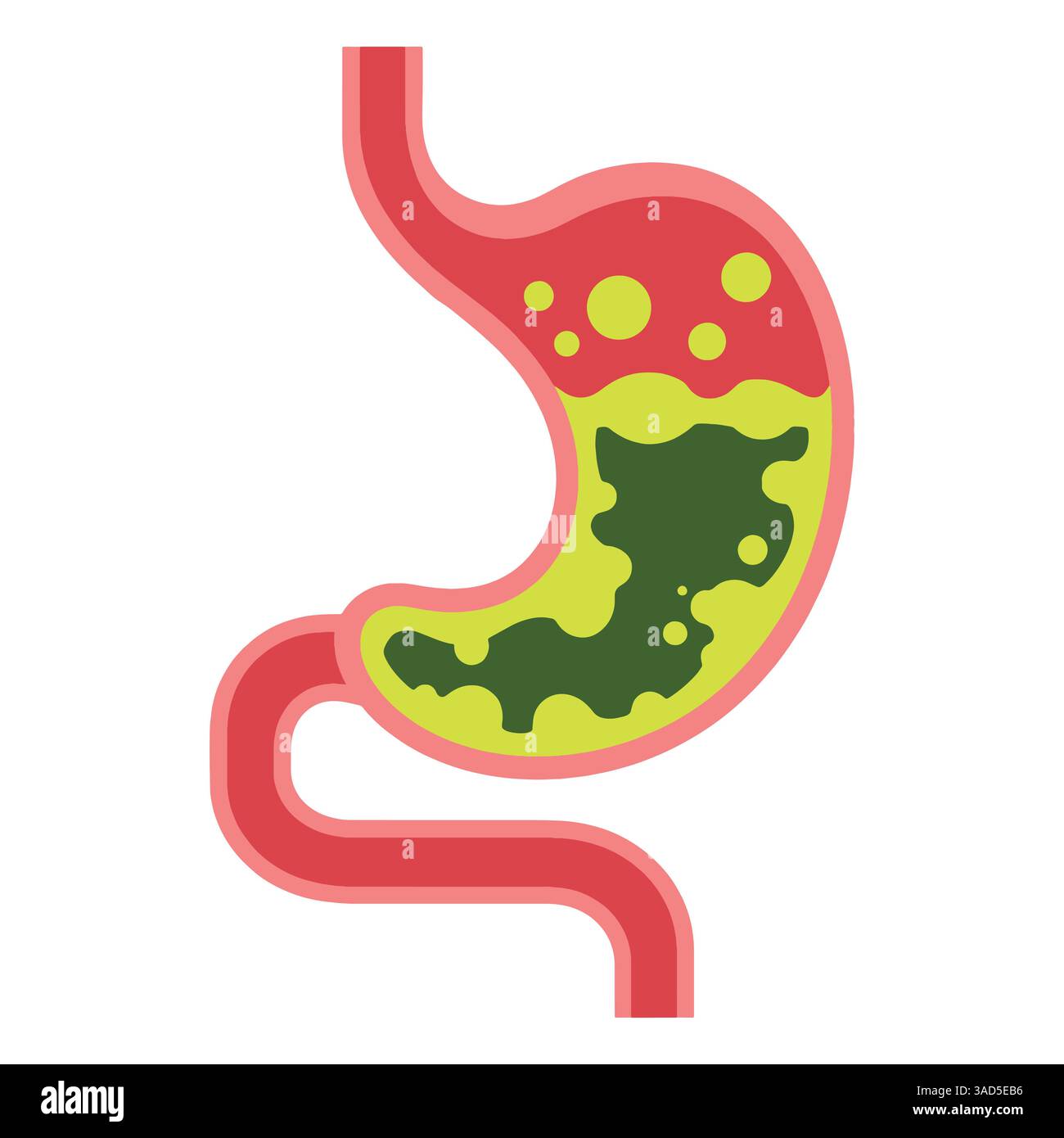 Human stomach vector illustration. Depicts gastritis, acid reflux, indigestion, heartburn, and ...