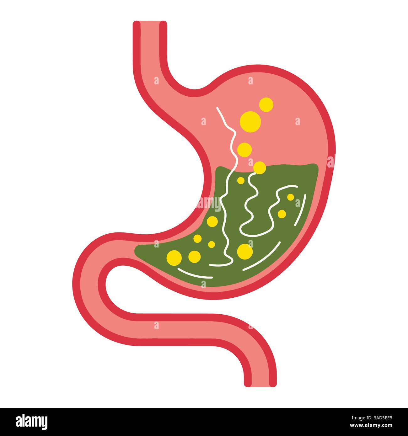 Human stomach vector illustration. Depicts gastritis, acid reflux, indigestion, heartburn, and ...