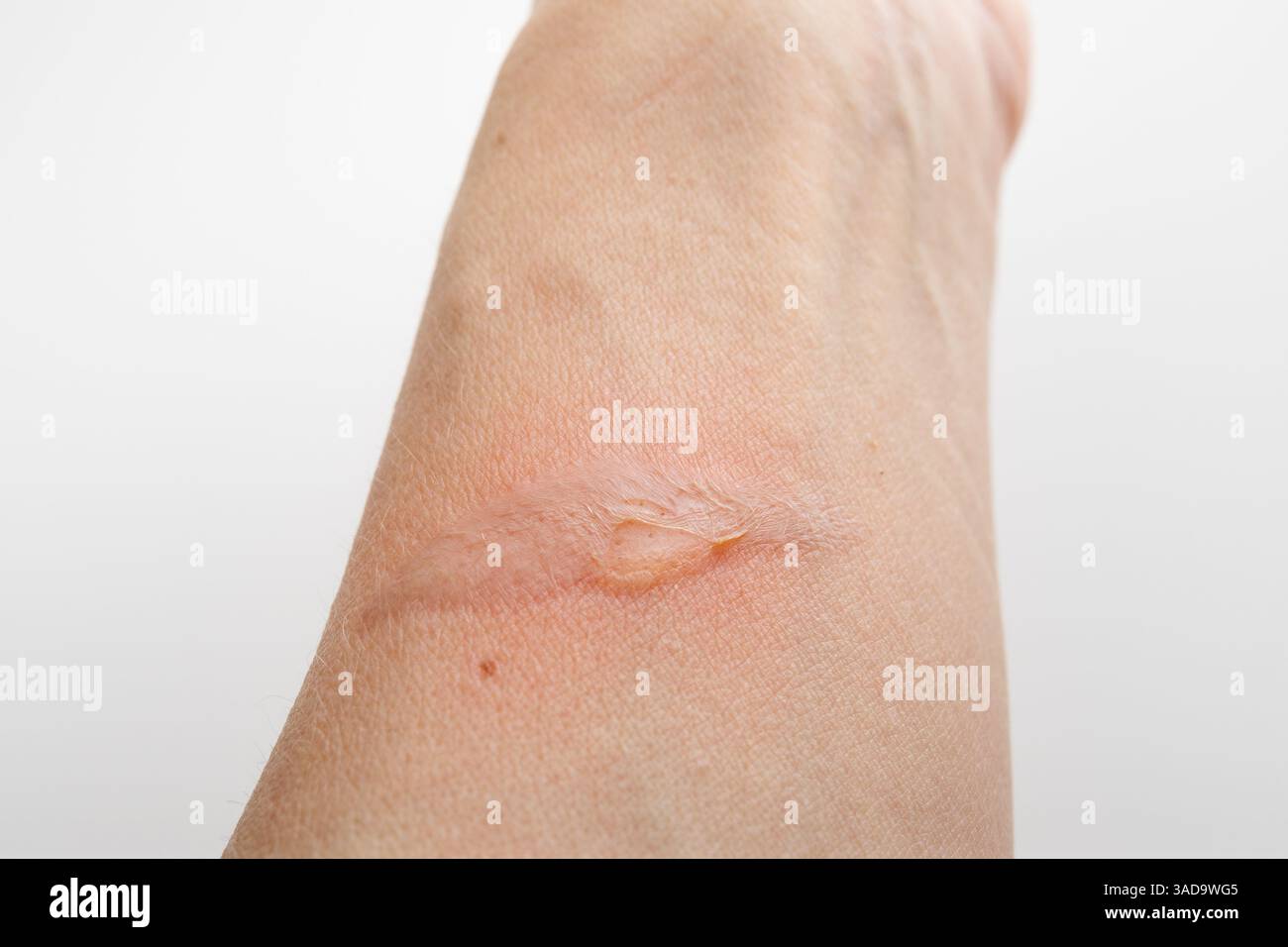 First degree burn hi-res stock photography and images - Alamy
