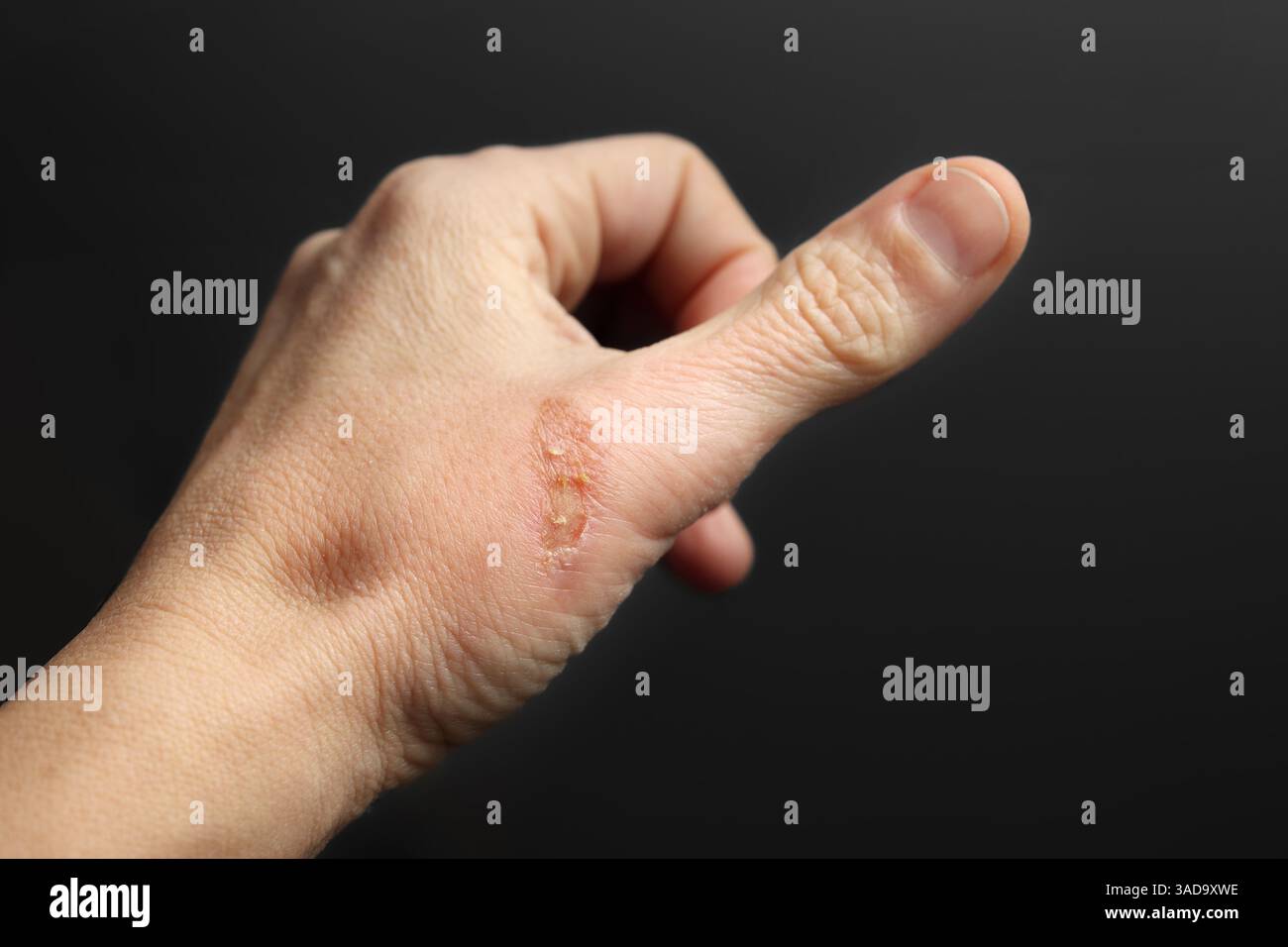 First degree burn on hand with dark background. Fluid filled wound with ...