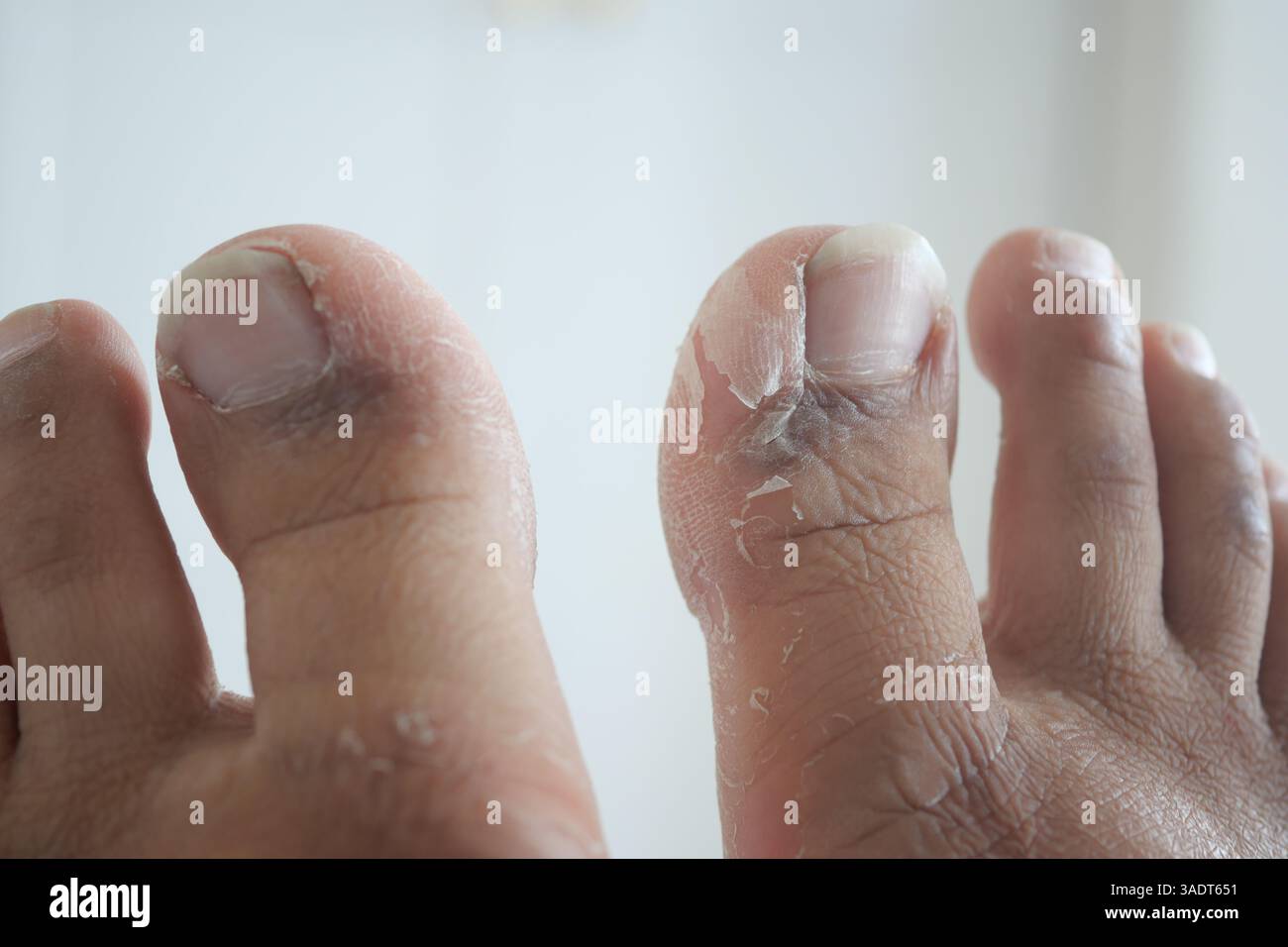 Dry and cracked feet in need of care and attention at home Stock Photo ...