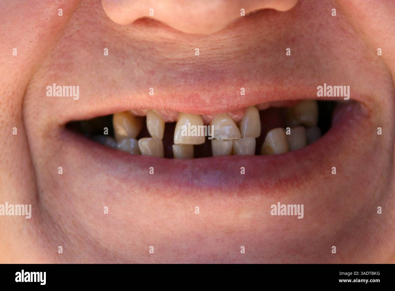 Dental problem bad teeth loss hi-res stock photography and images - Alamy